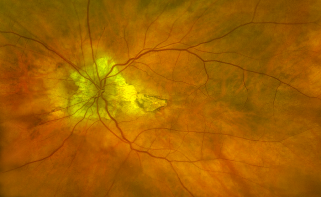 Linkes Auge: Makulaödem bei Myopia magna Copy