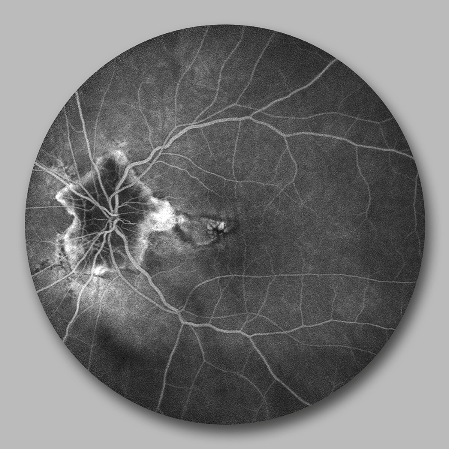 Linkes Auge: Makulaödem bei Myopia magna Copy