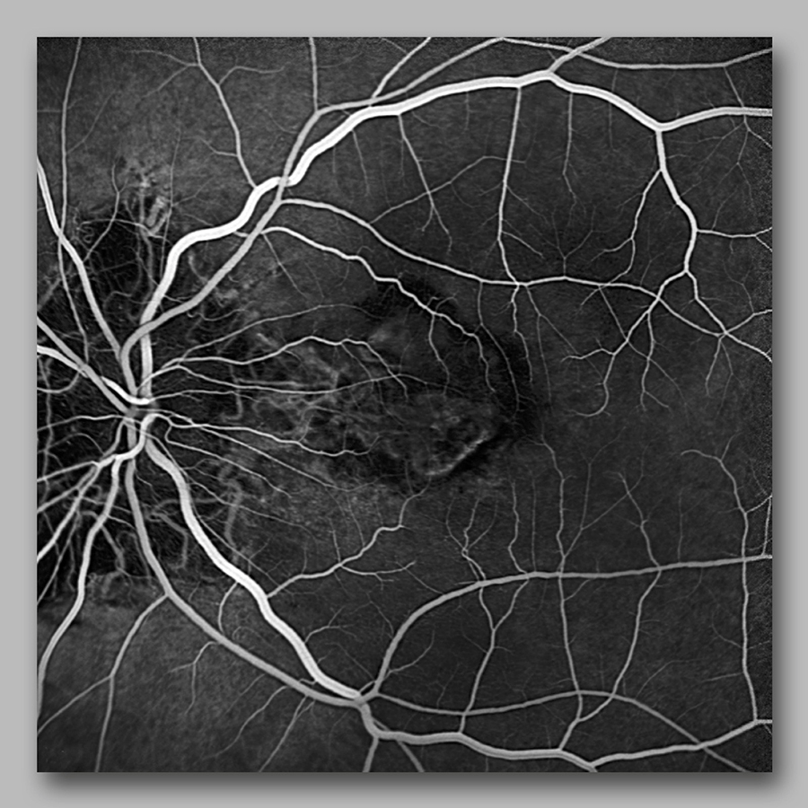 Linkes Auge: Makulaödem bei Myopia magna Copy