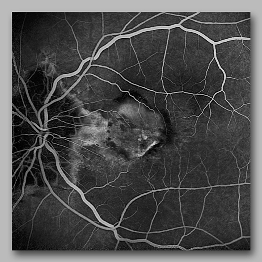Linkes Auge: Makulaödem bei Myopia magna Copy