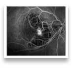 Rechtes Auge: Makulaödem bei Myopia magna