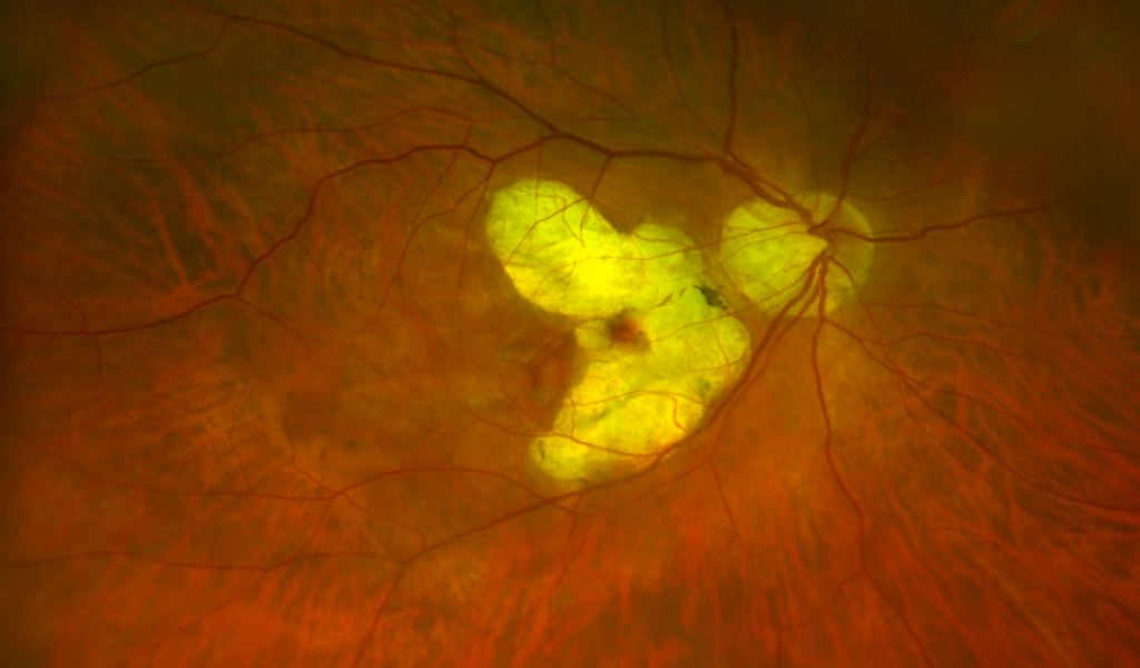 Rechtes Auge: Makulaödem bei Myopia magna