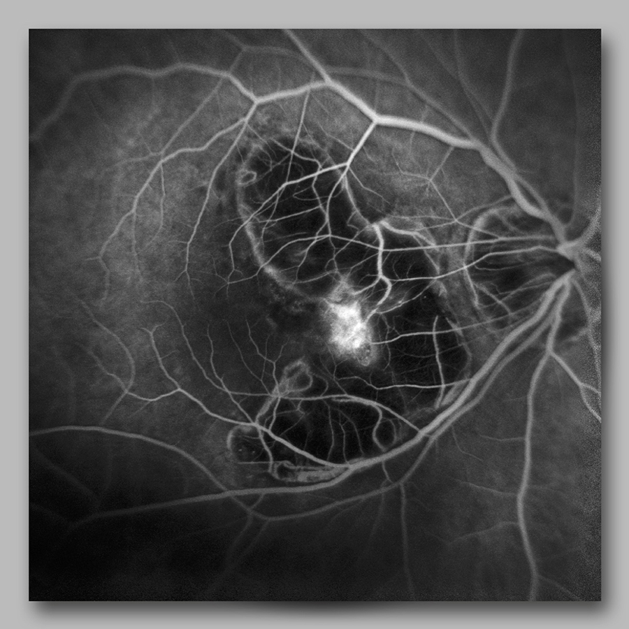 Rechtes Auge: Makulaödem bei Myopia magna