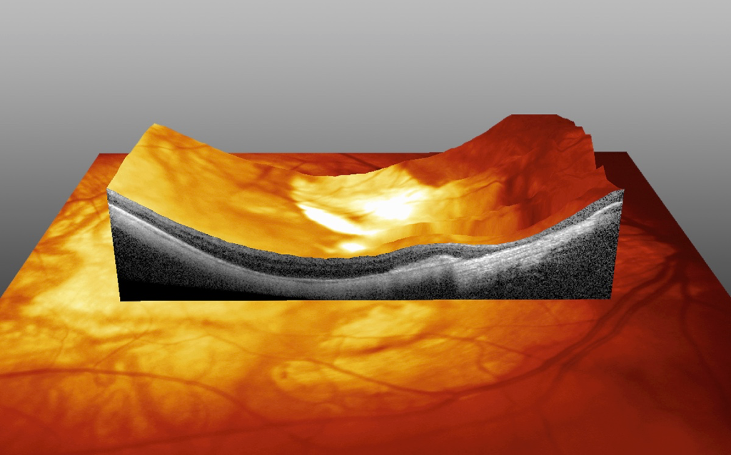Rechtes Auge: Makulaödem bei Myopia magna
