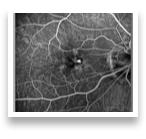 Neovascular AMD