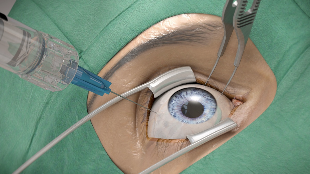 Iniezione intravitreale