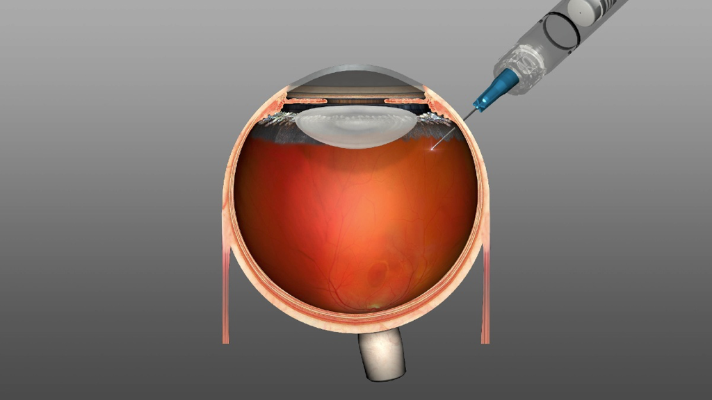 Iniezione intravitreale