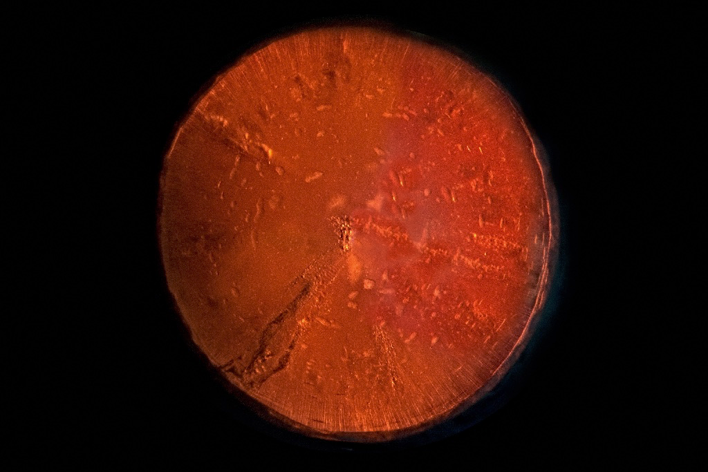 Corticonuclear cataract