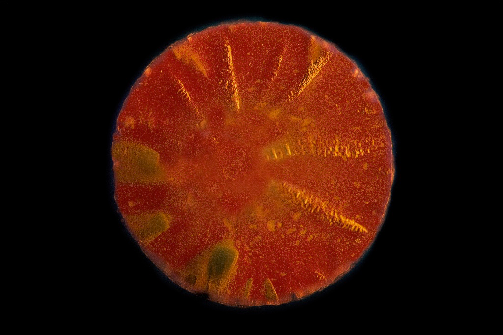 Corticonuclear cataract