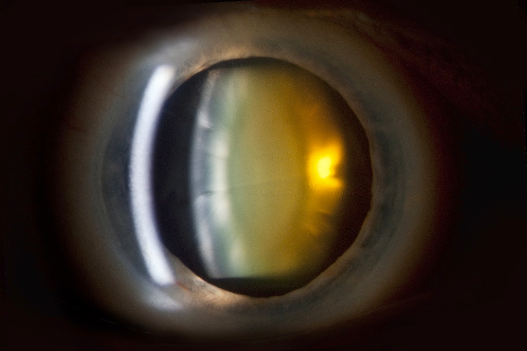 Corticonuclear cataract