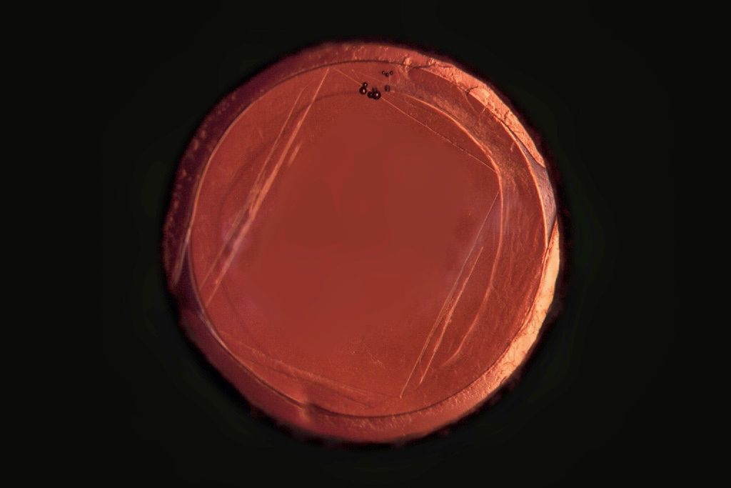 Status post YAG laser treatment