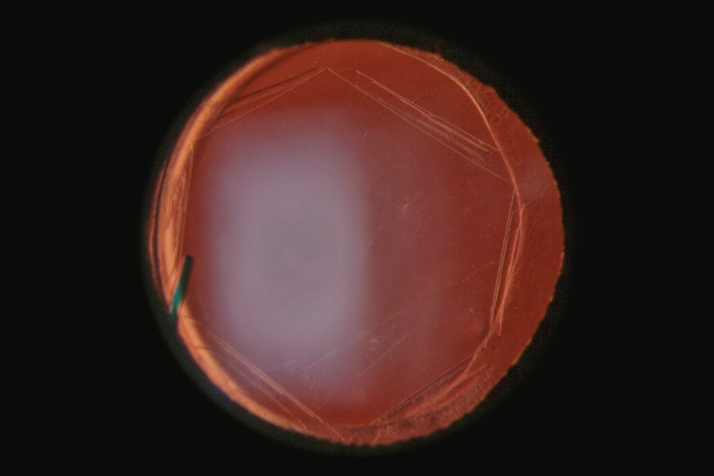 Status post YAG laser treatment